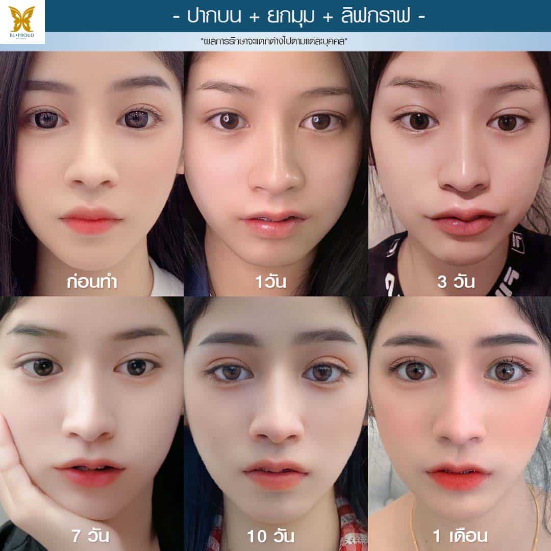 วิธีดูแลตัวเอง หลังทําปากกระจับ และการป้องกันปากกระจับคลายตัว | BeProud ...